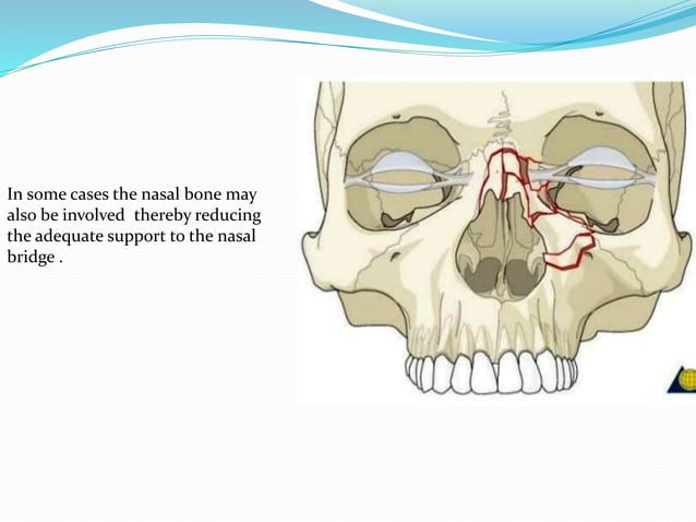 Surgical anatomy of Noe complex in context of trauma | PPT