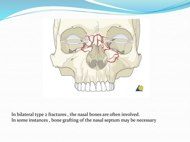 Surgical anatomy of Noe complex in context of trauma | PPT