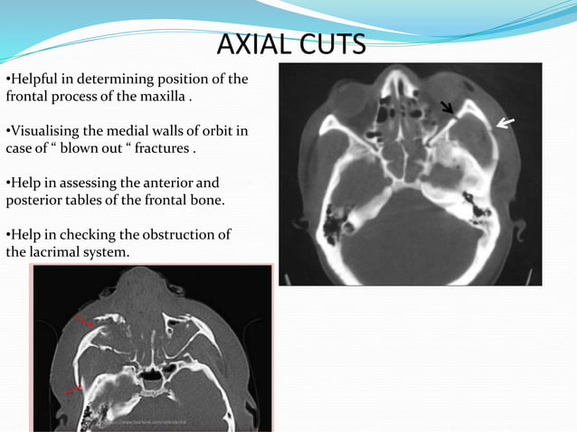 Surgical anatomy of Noe complex in context of trauma | PPT