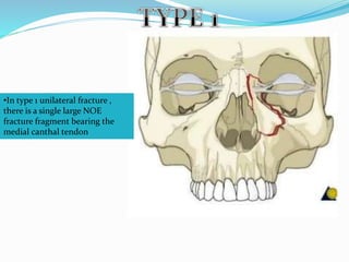 Surgical anatomy of Noe complex in context of trauma | PPT