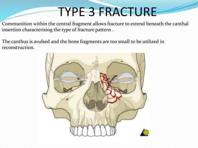 Surgical anatomy of Noe complex in context of trauma