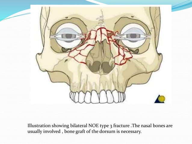 Surgical anatomy of Noe complex in context of trauma