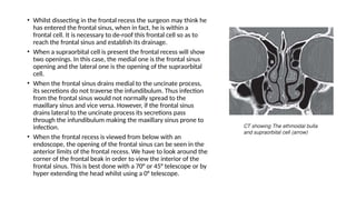 SURGICAL ANATOMY OF NOSE.pptxjfkenwbhzuxn | PPT