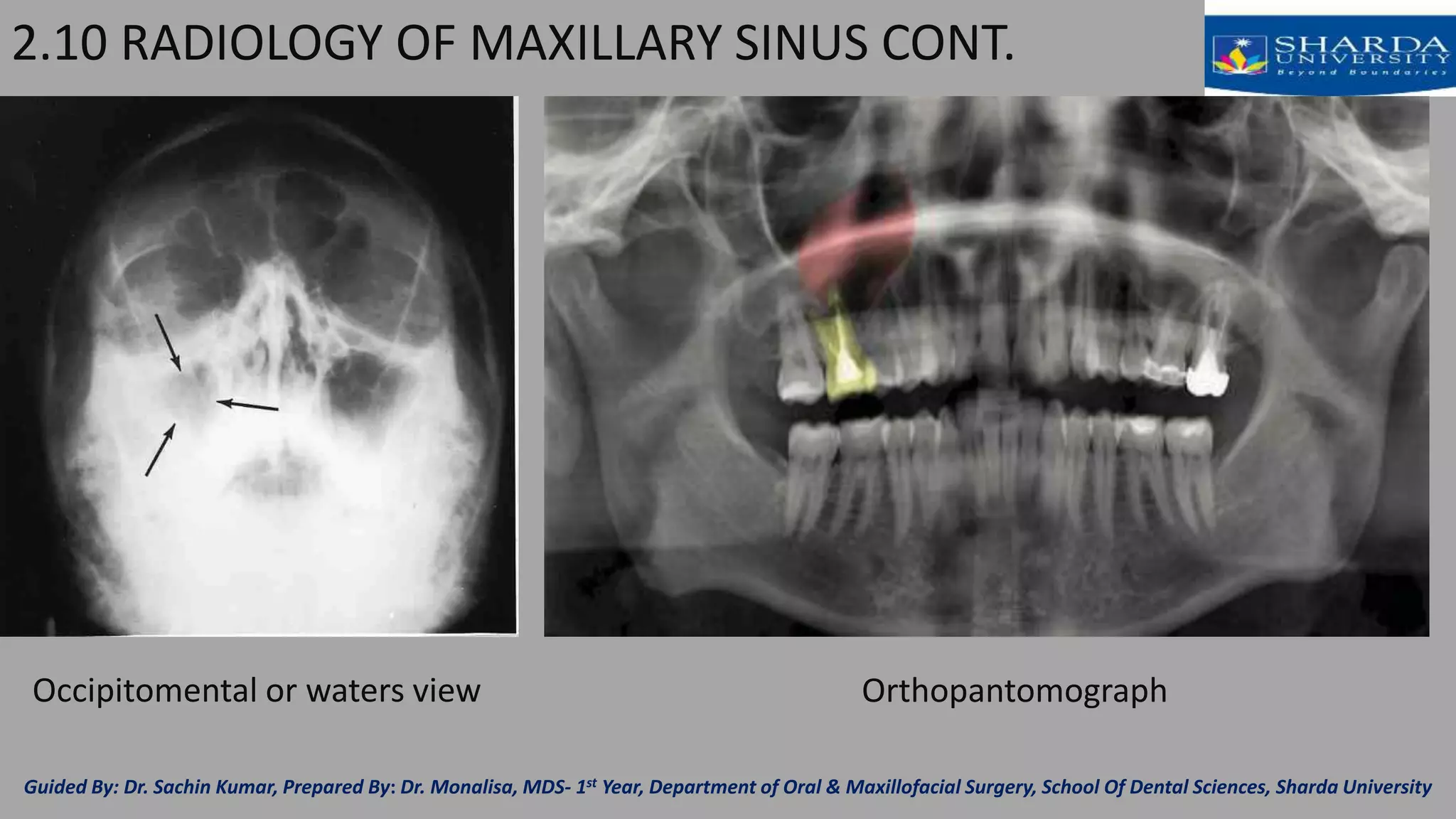 Surgical anatomy of nose and maxilliary sinus.pptx [autosaved] | PPTX