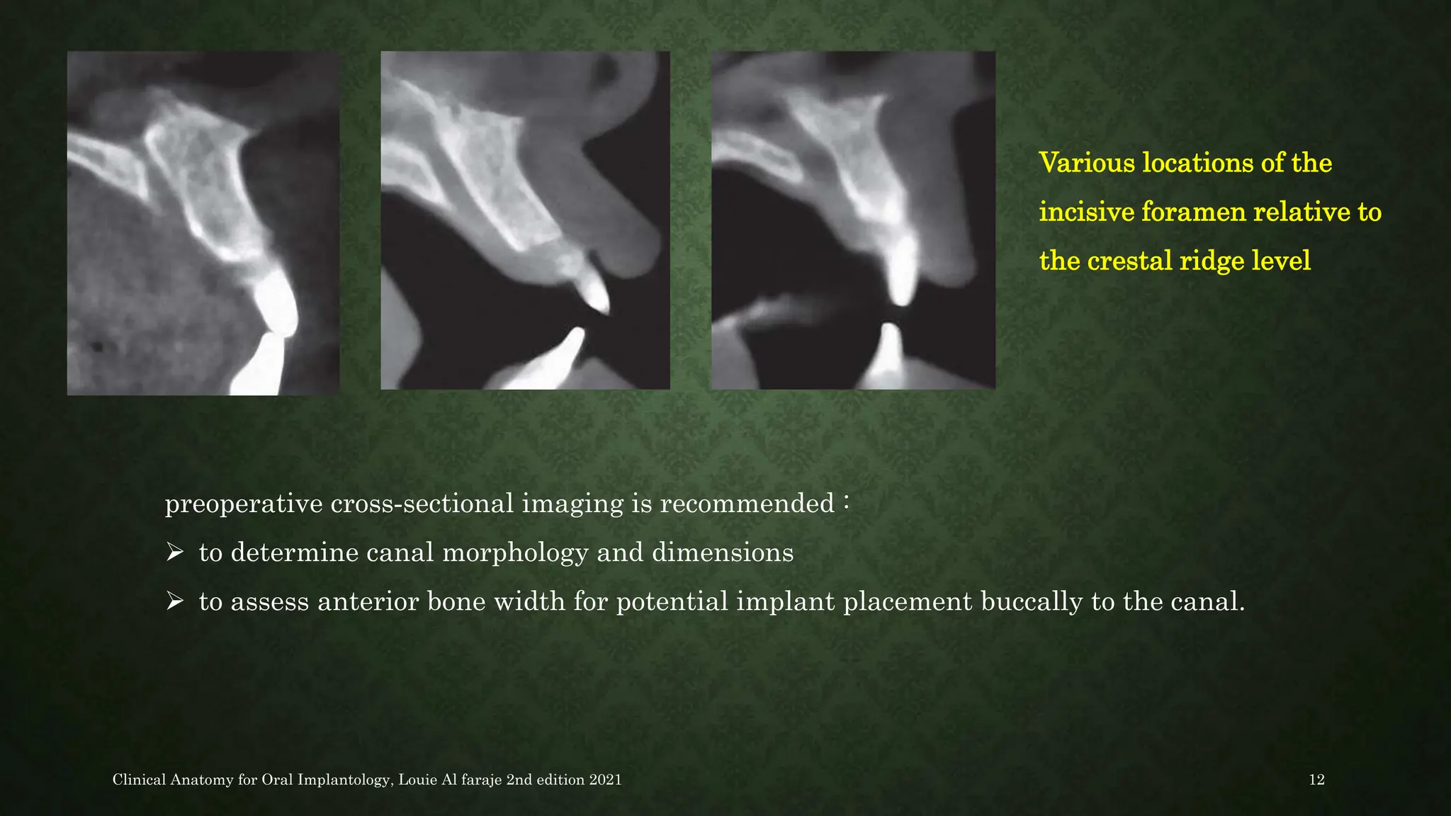 SURGICAL ANATOMY OF ORAL IMPLANTOLOGY.pptx