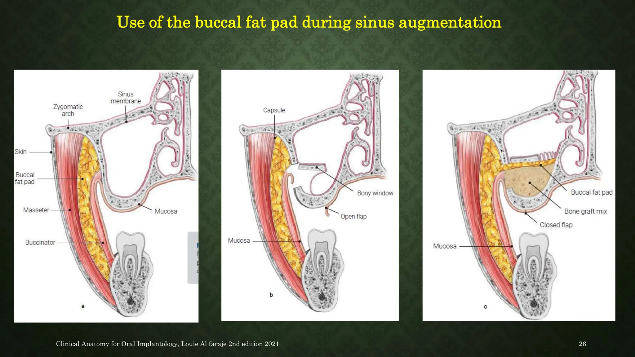 SURGICAL ANATOMY OF ORAL IMPLANTOLOGY.pptx