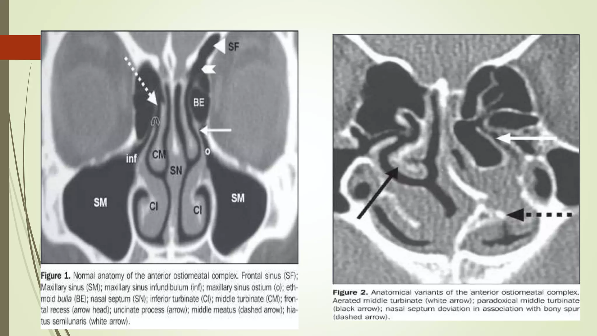 Surgical anatomy of osteomeatal complex | PPTX