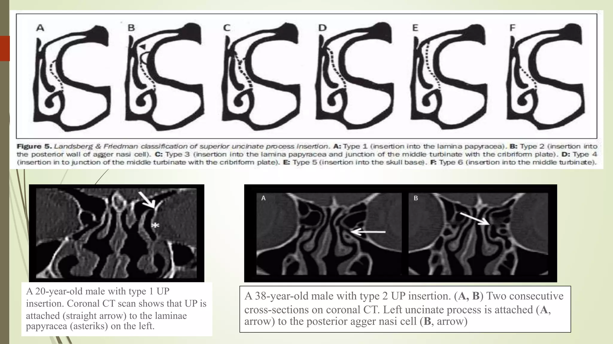 Surgical anatomy of osteomeatal complex | PPTX