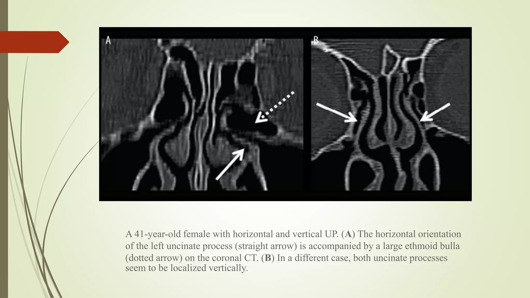 Surgical anatomy of osteomeatal complex | PPTX