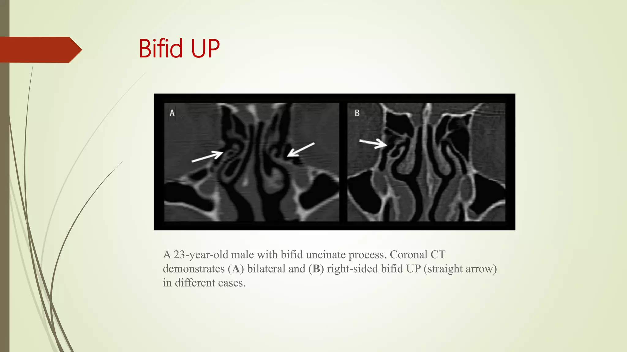 Surgical anatomy of osteomeatal complex | PPTX