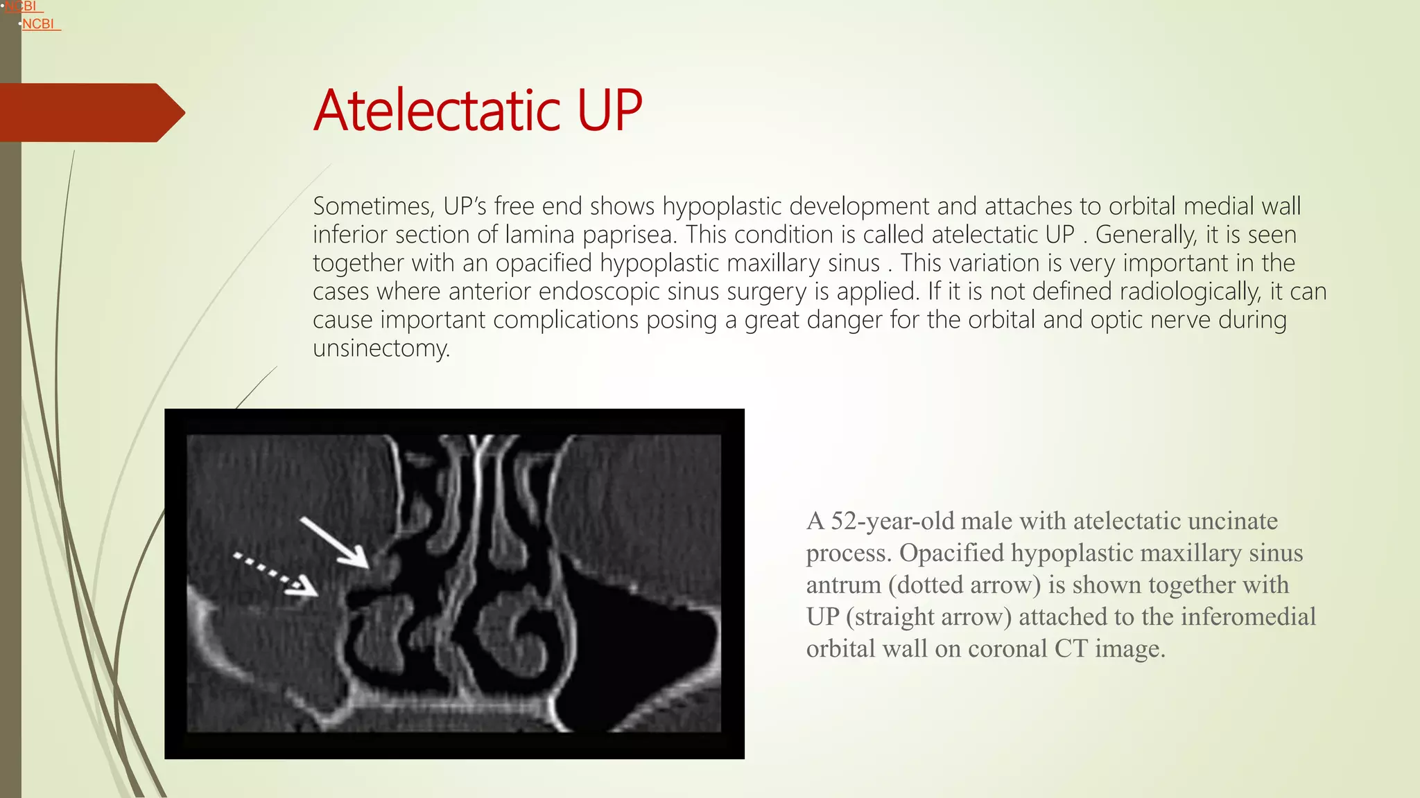 Surgical anatomy of osteomeatal complex | PPTX