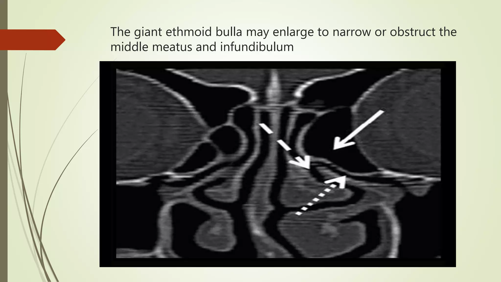 Surgical anatomy of osteomeatal complex | PPTX