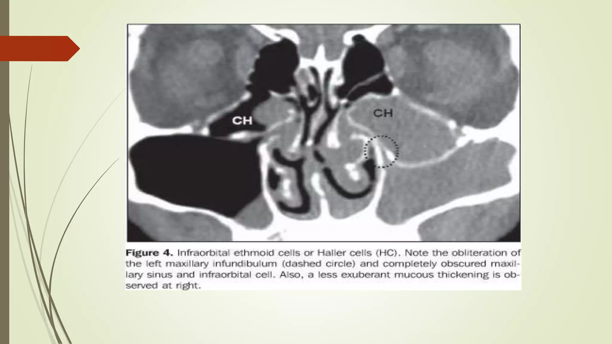 Surgical anatomy of osteomeatal complex | PPTX