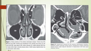 Surgical anatomy of osteomeatal complex | PPTX