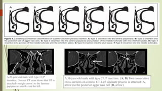 Surgical anatomy of osteomeatal complex | PPTX
