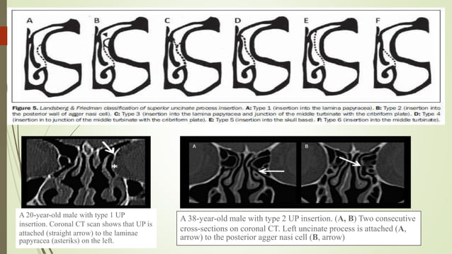 Surgical anatomy of osteomeatal complex | PPTX