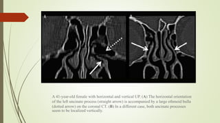 Surgical anatomy of osteomeatal complex | PPTX
