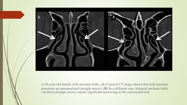 Surgical anatomy of osteomeatal complex | PPTX