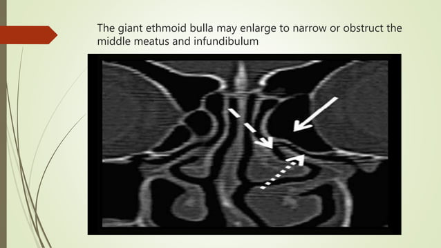 Surgical anatomy of osteomeatal complex | PPTX