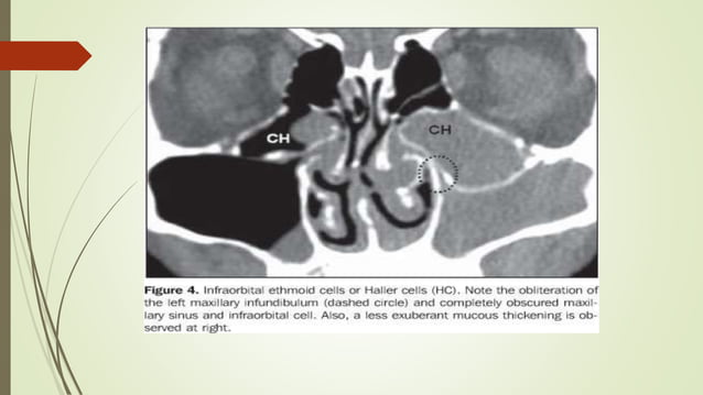Surgical anatomy of osteomeatal complex | PPTX