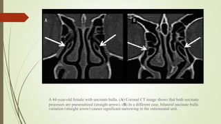 Surgical anatomy of osteomeatal complex | PPT