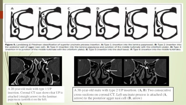 Surgical anatomy of osteomeatal complex