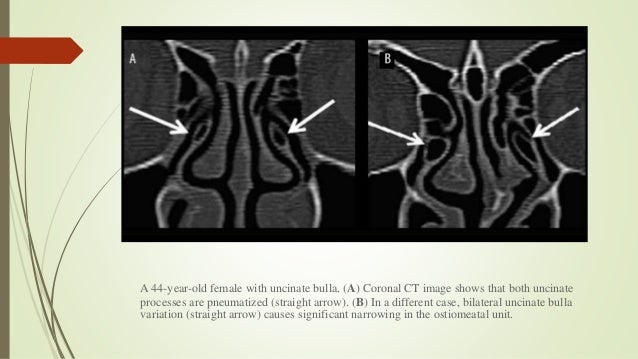 Surgical anatomy of osteomeatal complex