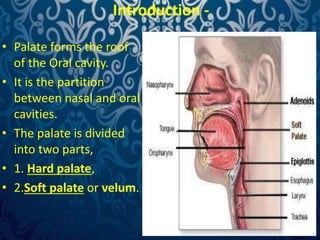 Surgical anatomy of palate. by Dr. Amit T. Suryawanshi, Oral Surgeon ...