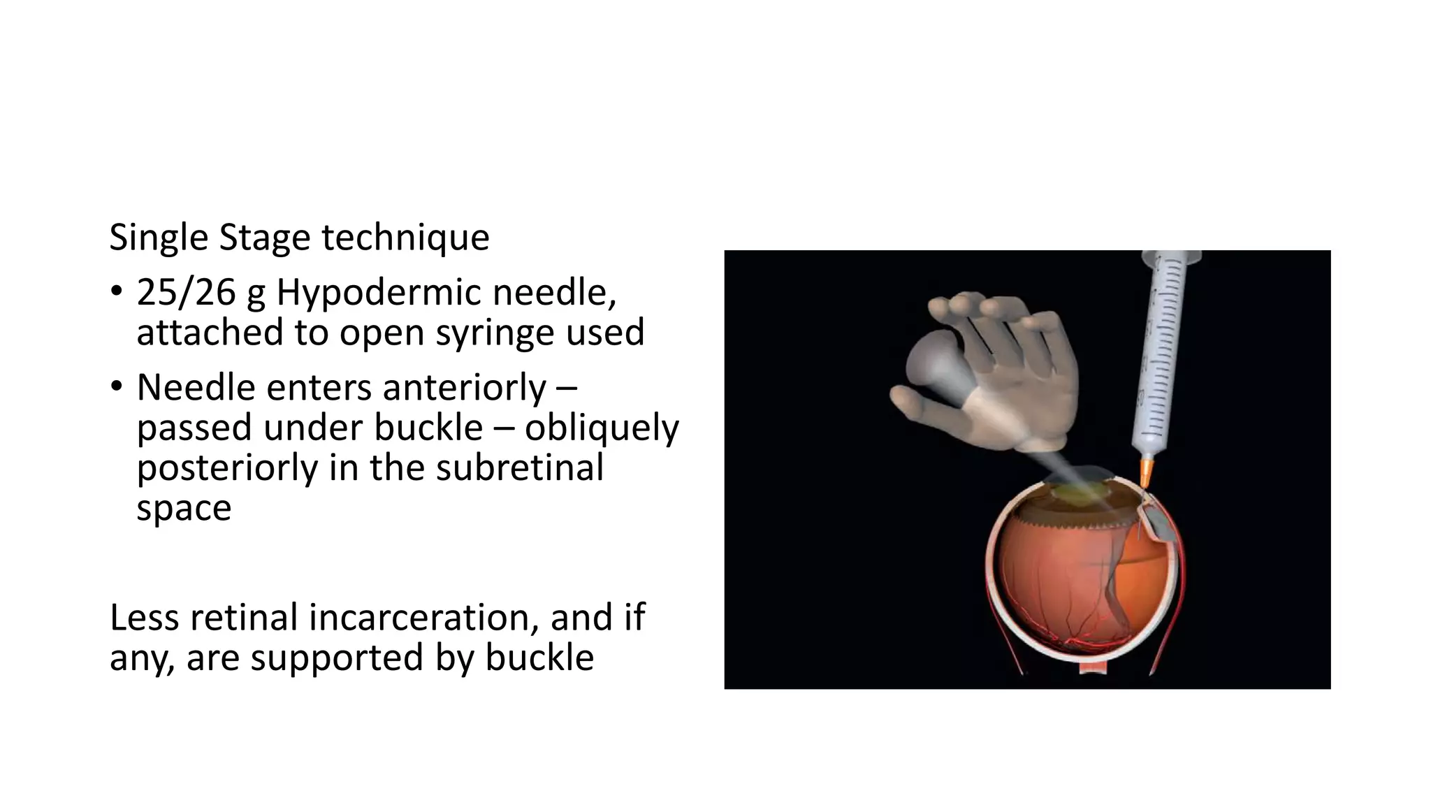 Surgical anatomy of retina | PPTX