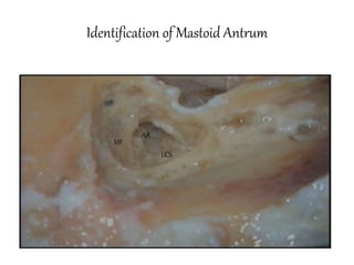 SURGICAL ANATOMY OF TB - 2017.pptx