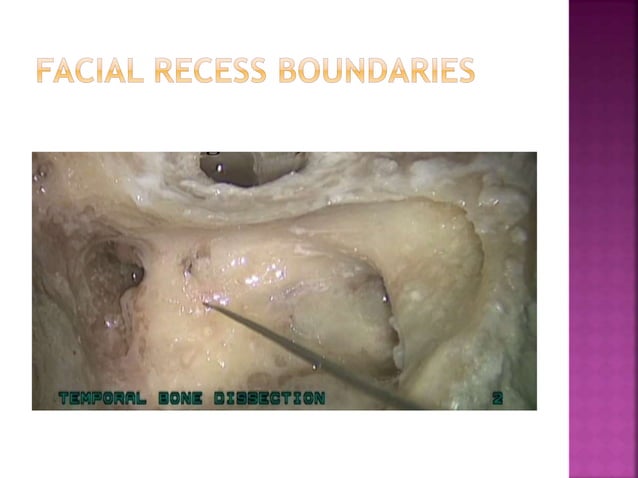 Surgical anatomy of temporal bone dr zeeshan ent lucknow | PPTX | Ear ...