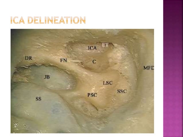 Surgical anatomy of temporal bone dr zeeshan ent lucknow | PPTX | Ear ...