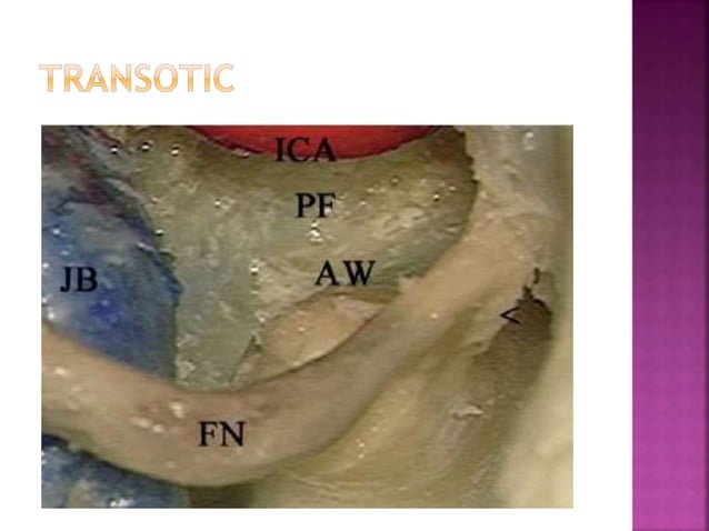 Surgical anatomy of temporal bone dr zeeshan ent lucknow | PPTX | Ear ...