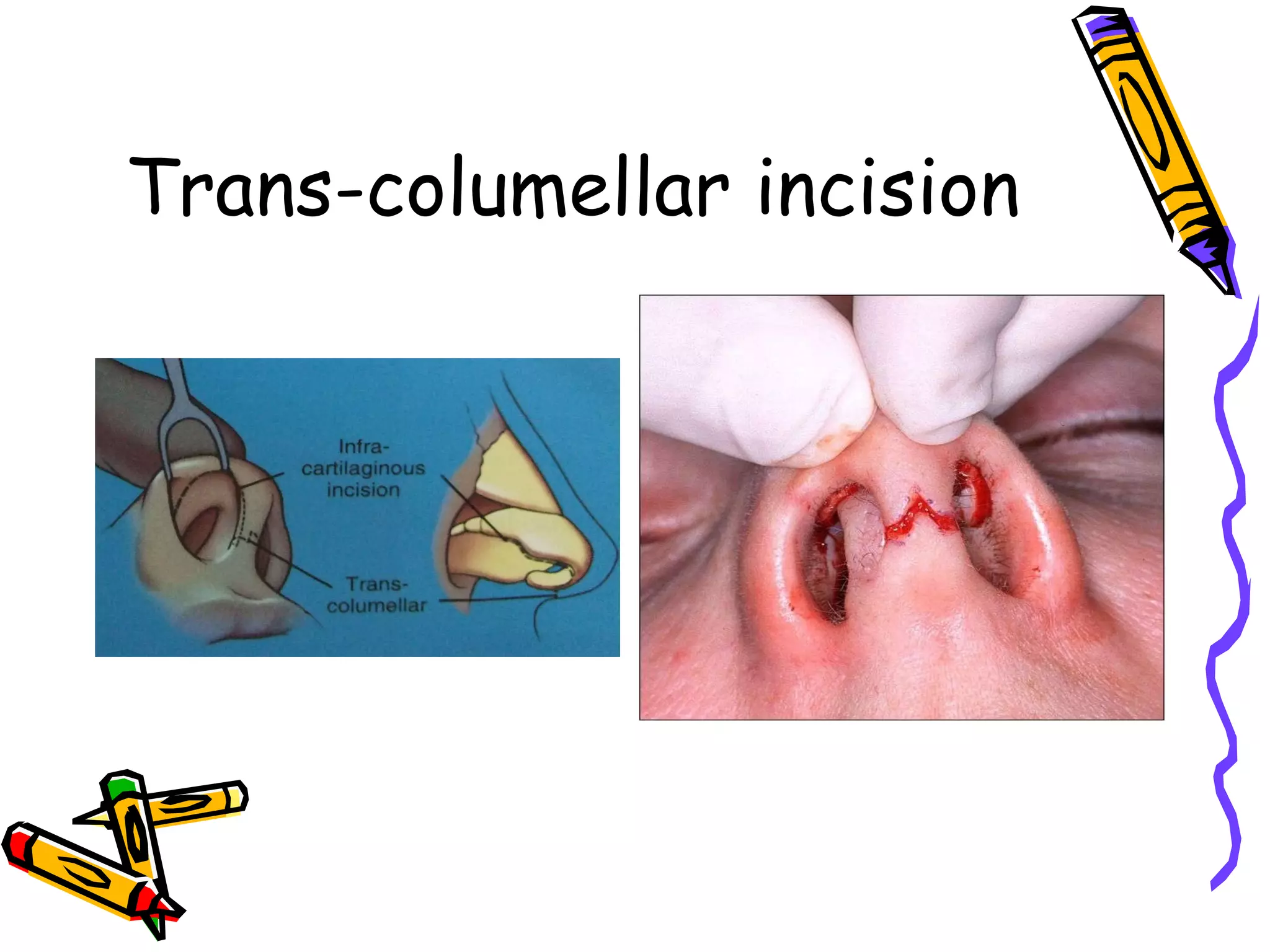 Surgical Anatomy Of The Nose | PPT