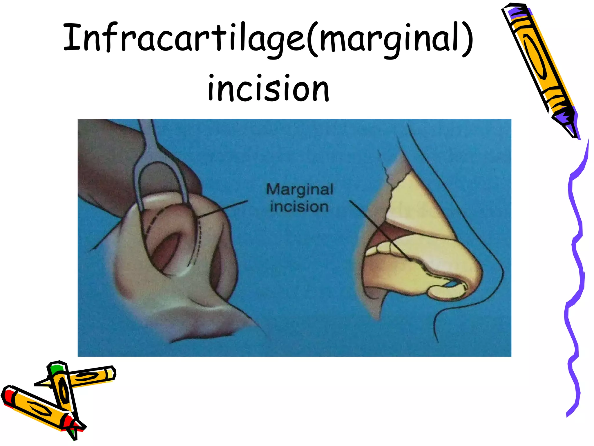 Surgical Anatomy Of The Nose | PPT