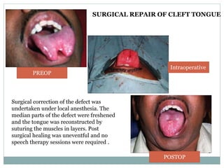 Surgical anatomy of tongue | PPTX