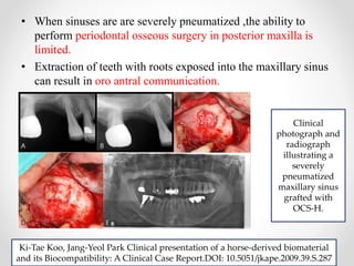 IMPORTANT ANATOMICAL CONSIDERATIONS IN PERIODONTAL SURGERY AND IMPLANTS ...