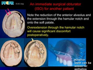 Surgical and interim obturation | PPT