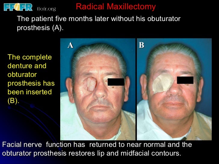 Surgical and interim obturation