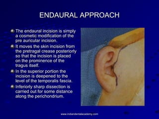 Surgical approaches of TMJ /certified fixed orthodontic courses by ...