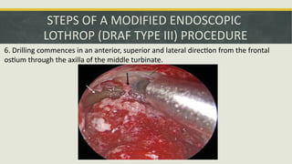 SURGICAL APPROACHES TO FRONTAL SINUS AND FRONTAL RECESS | PPTX