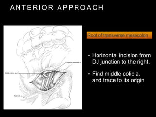Surgical approaches to abdominal vessels | PPTX