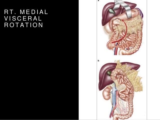 Surgical approaches to abdominal vessels