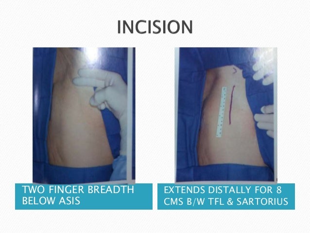 Surgical approaches to hip