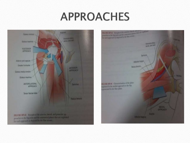 Surgical approaches to hip