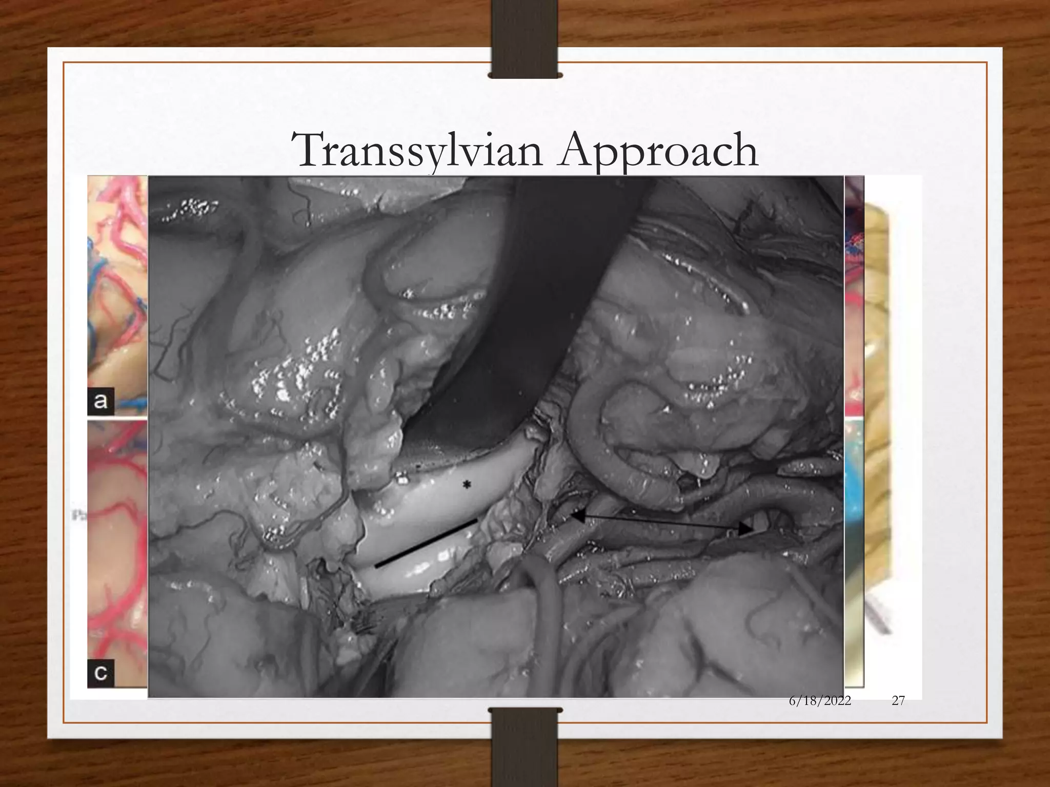 Surgical Approaches to intra-ventricular tumors (IVT).pptx