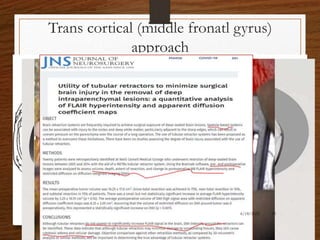 Surgical Approaches to intra-ventricular tumors (IVT).pptx