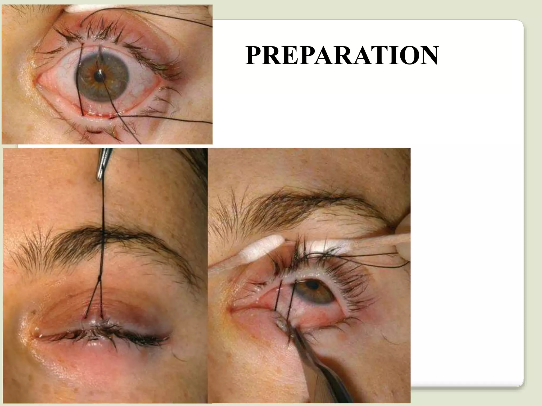 Surgical approaches to the facial skeleton | PPTX