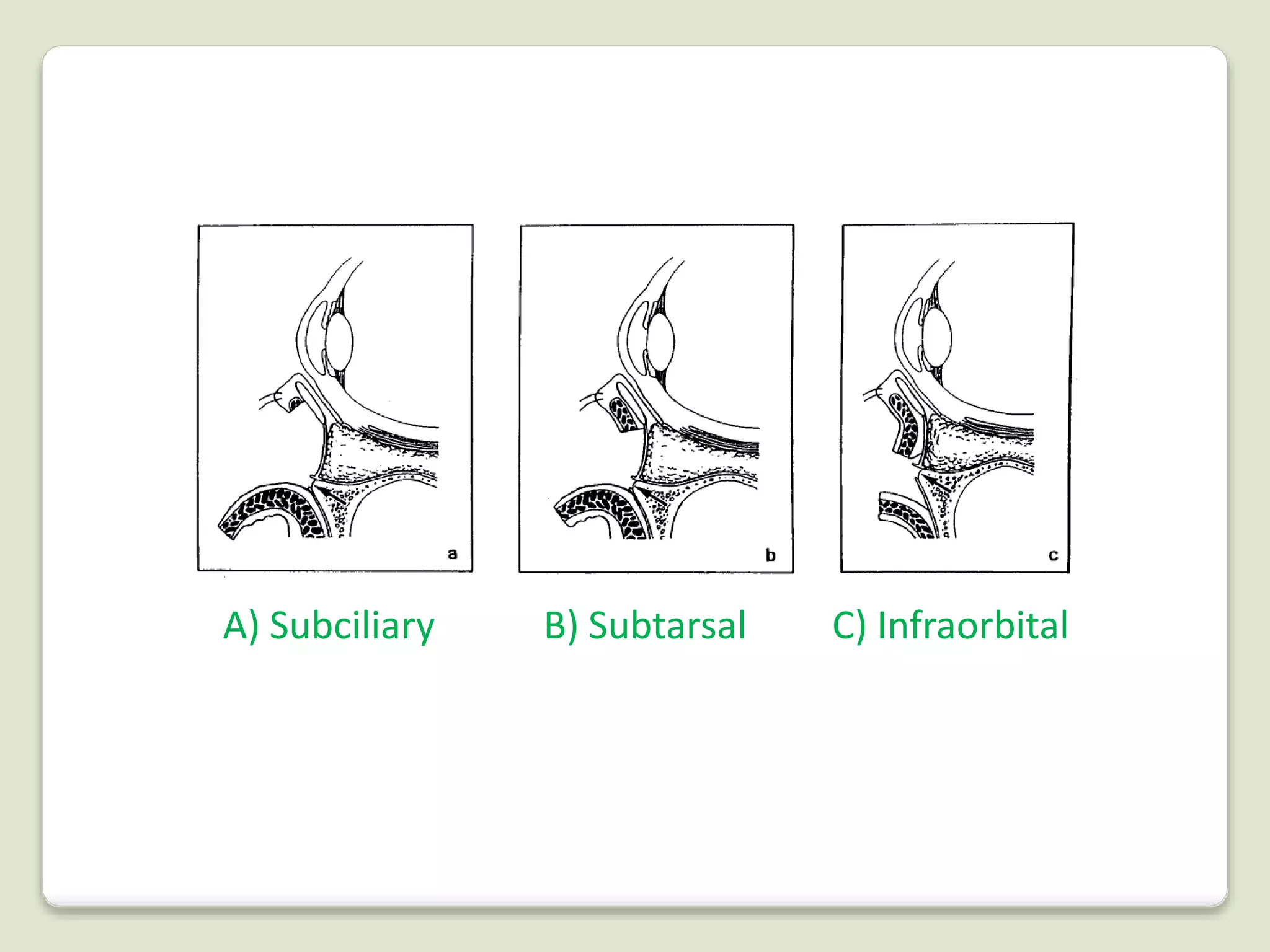 Surgical approaches to the facial skeleton | PPTX