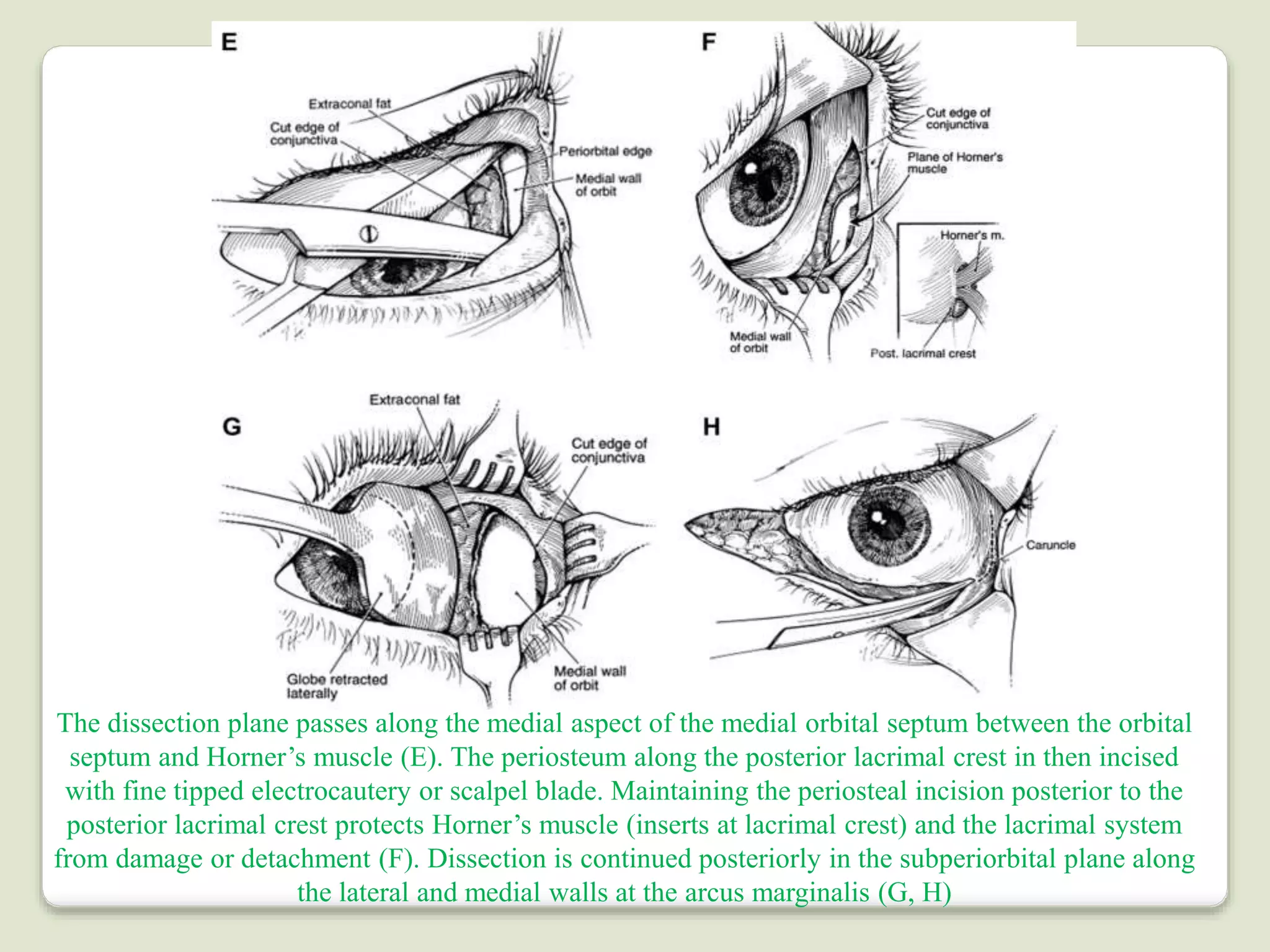 Surgical approaches to the facial skeleton | PPTX